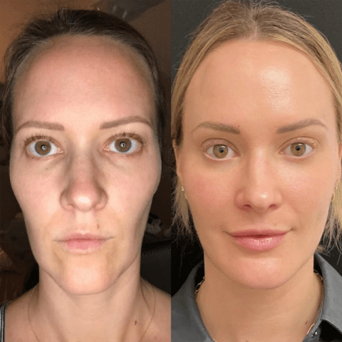 Facial Balancing Before and After Pictures - BOYD