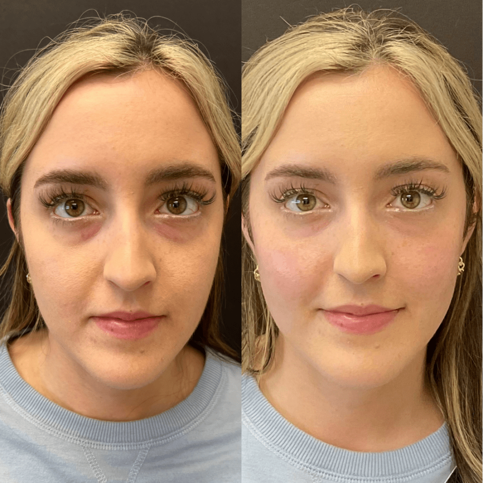 Tear Trough Before and After Pictures - BOYD